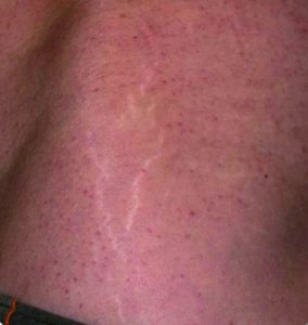 Estrías blancas y rojas: qué son y cómo eliminarlas - Alma Médica