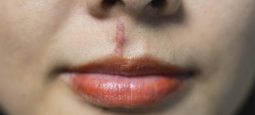 Labio Hendido Cuando Fue Descubierto