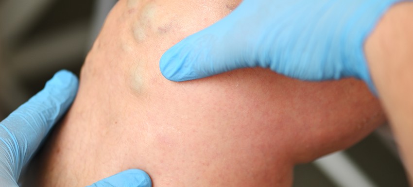 Tipos de lesiones vasculares: Causas y Síntomas