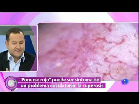 Cuperosis y rosacea: en qué se diferencian y cómo tratarlas - Alma Médica